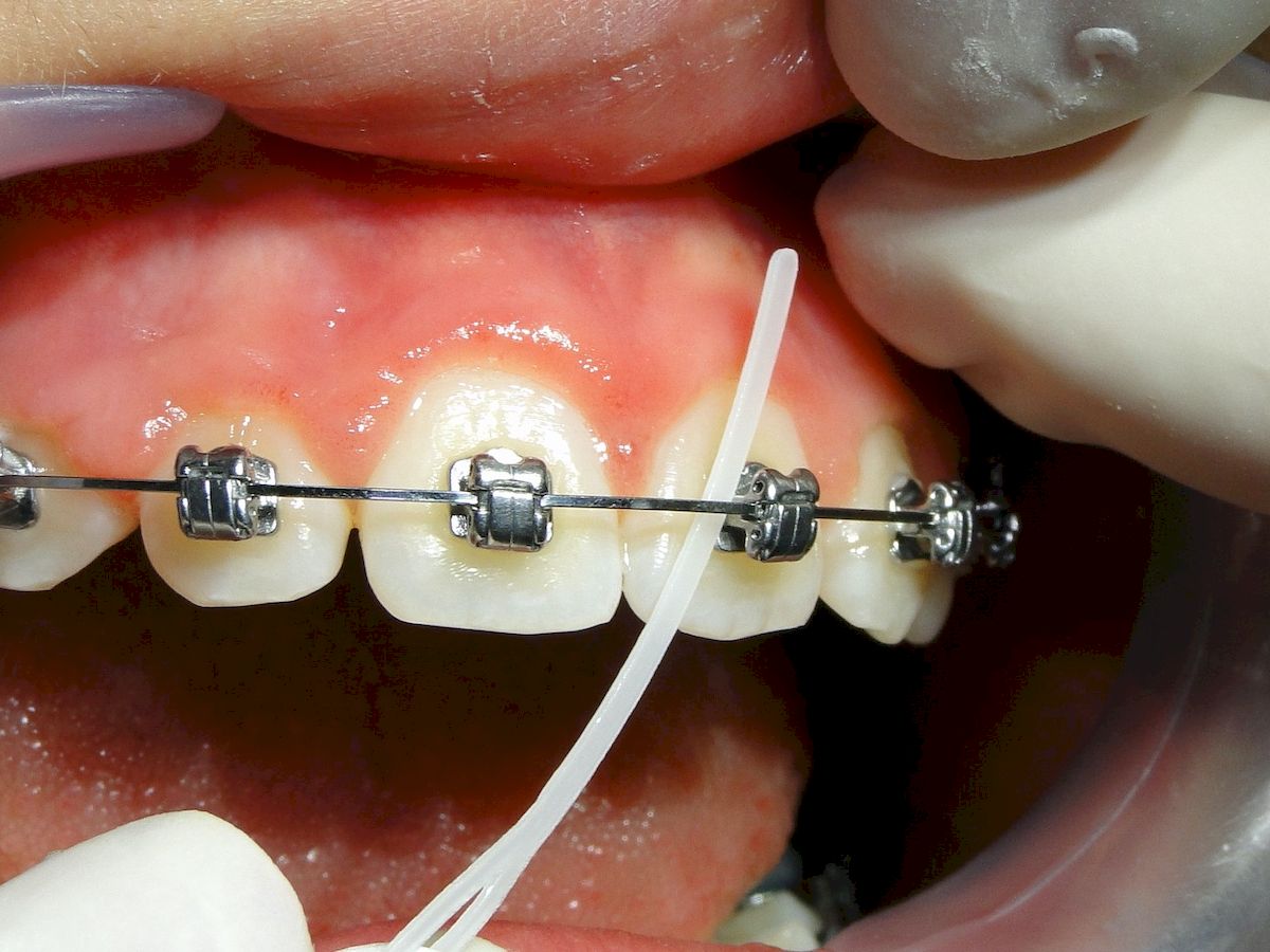 Aprenda como limpar bem os dentes mesmo com aparelho ortodôntico ...